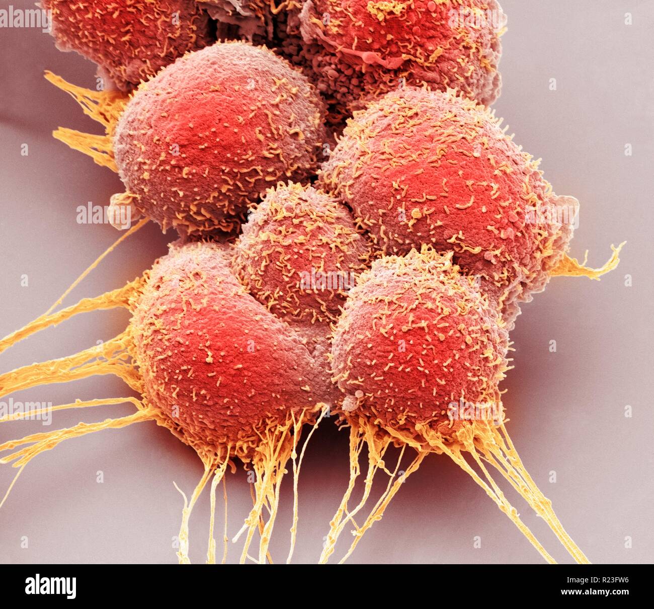 Prostate cancer cells, Coloured scanning electron micrograph (SEM ...