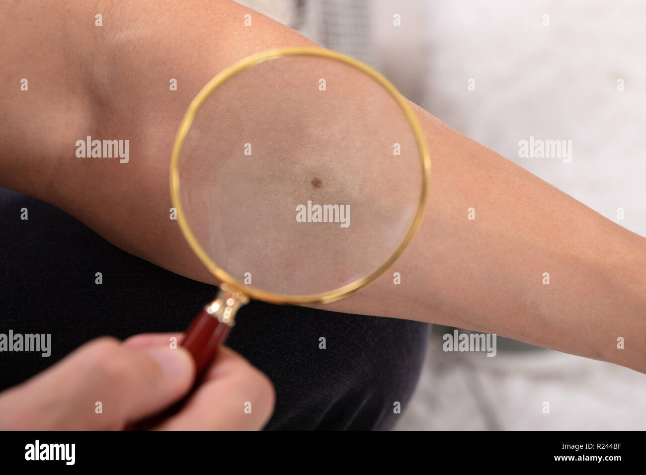 Verruca hi-res stock photography and images - Alamy