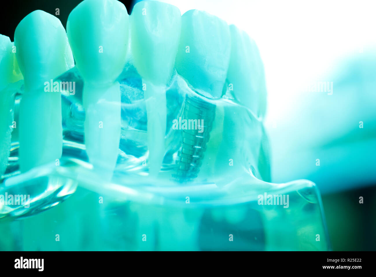 Dentist dental teeth teaching model showing titanium metal tooth ...