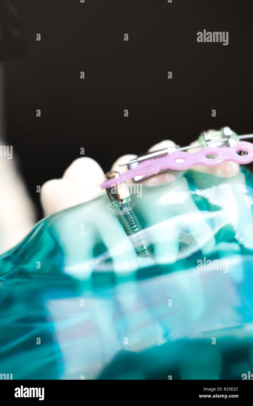 Dental metal braces teeth retainer aligners teaching orthodontics model ...