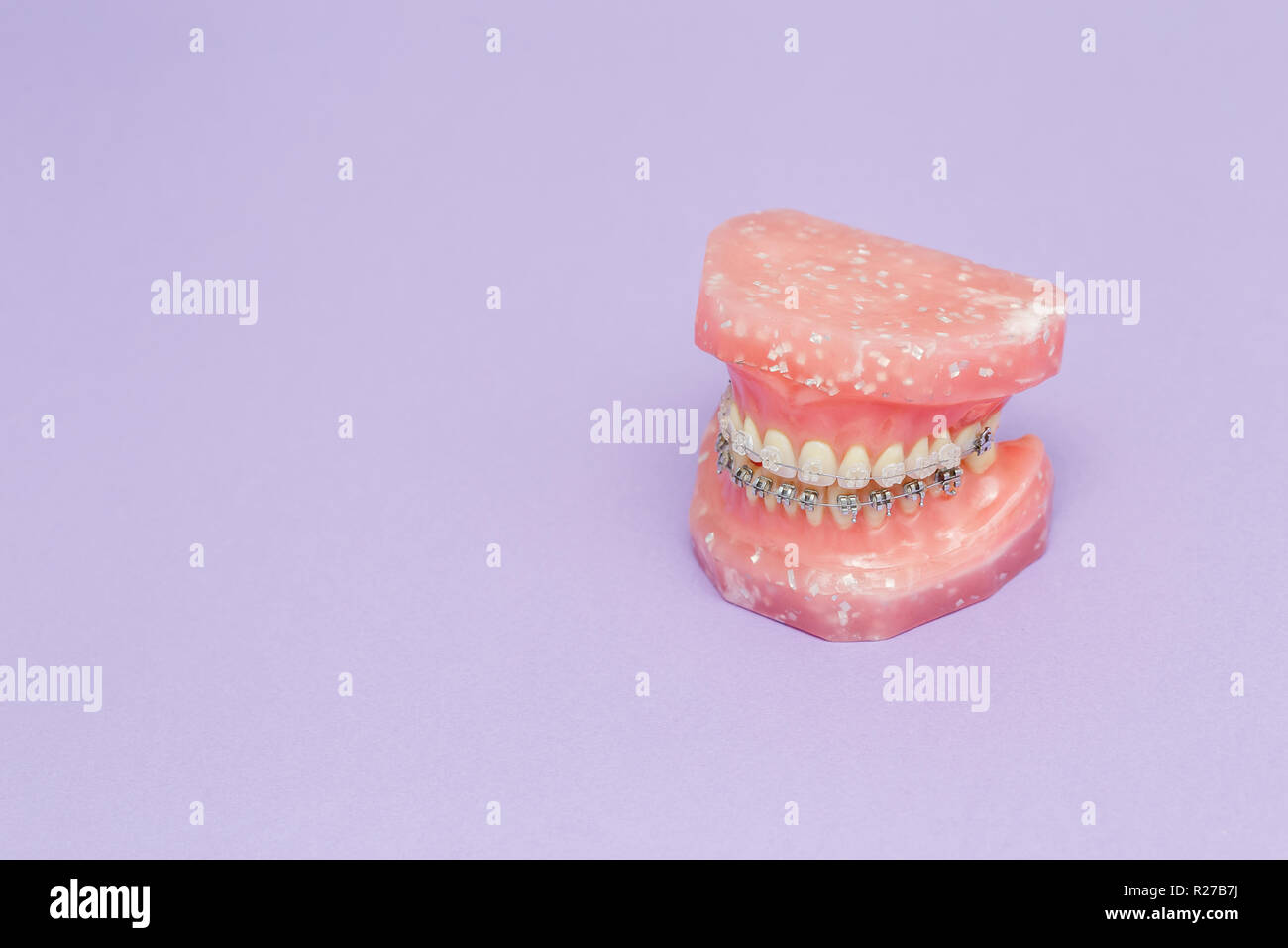 Human jaw or teeth model with metal wired dental braces and closeup ...