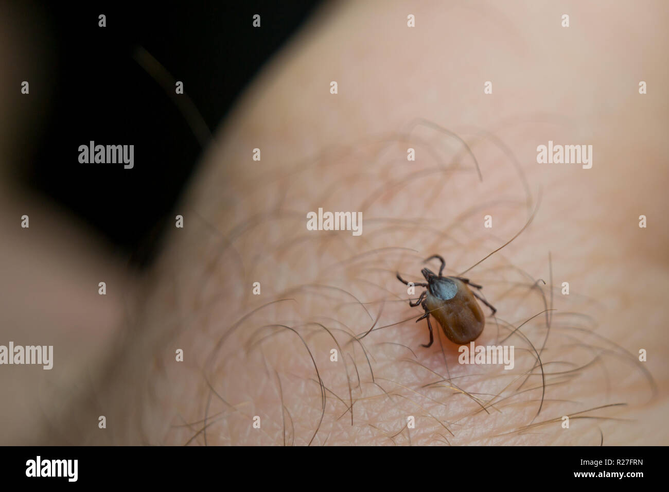 Adult tick on the human skin surface Stock Photo - Alamy