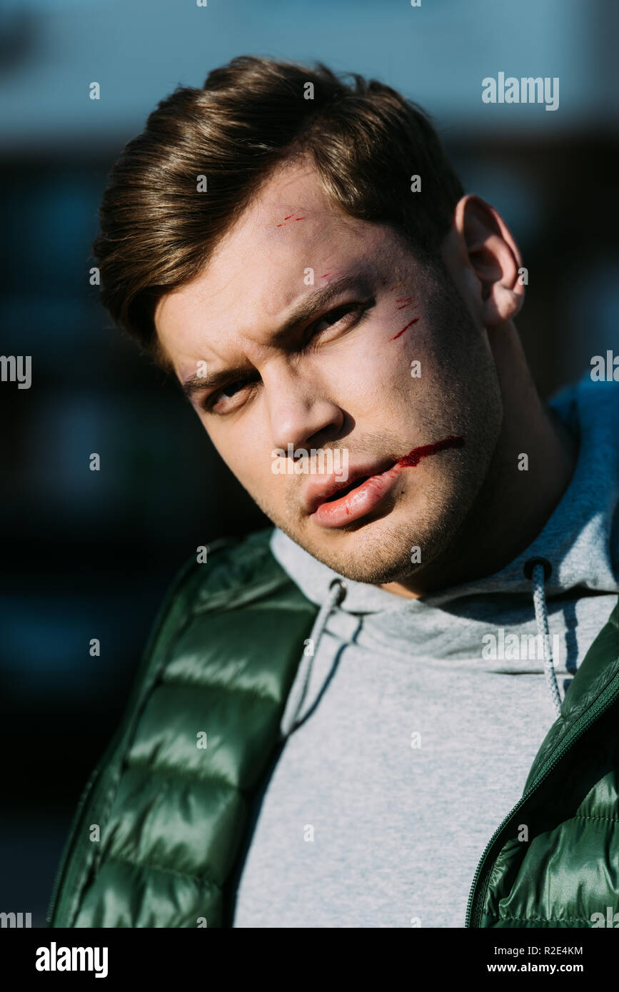 Face after accident hi-res stock photography and images - Alamy