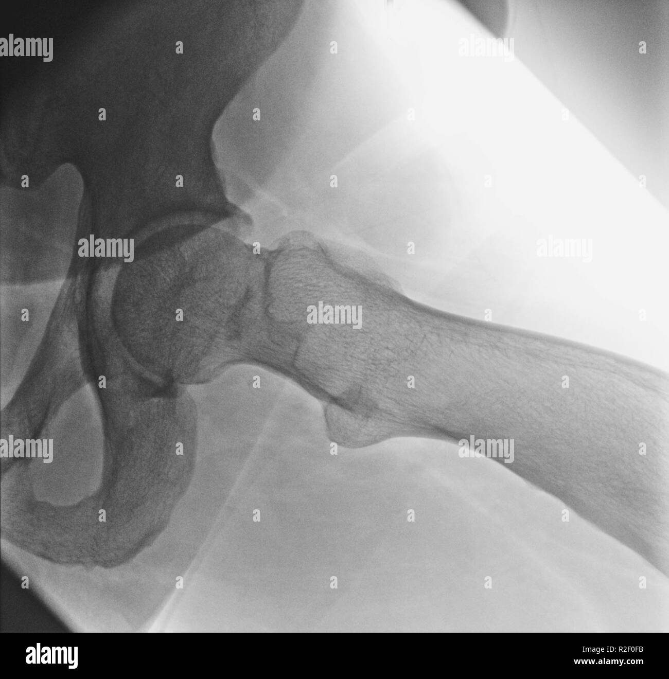 Sick legs Black and White Stock Photos & Images - Alamy