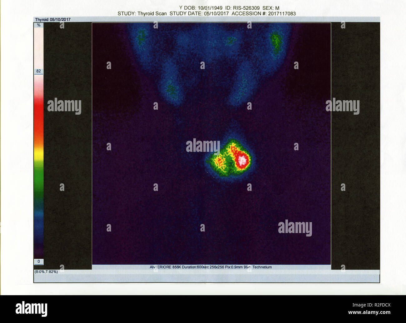 Thyroid Gland Scintigraphy Stock Photo - Alamy