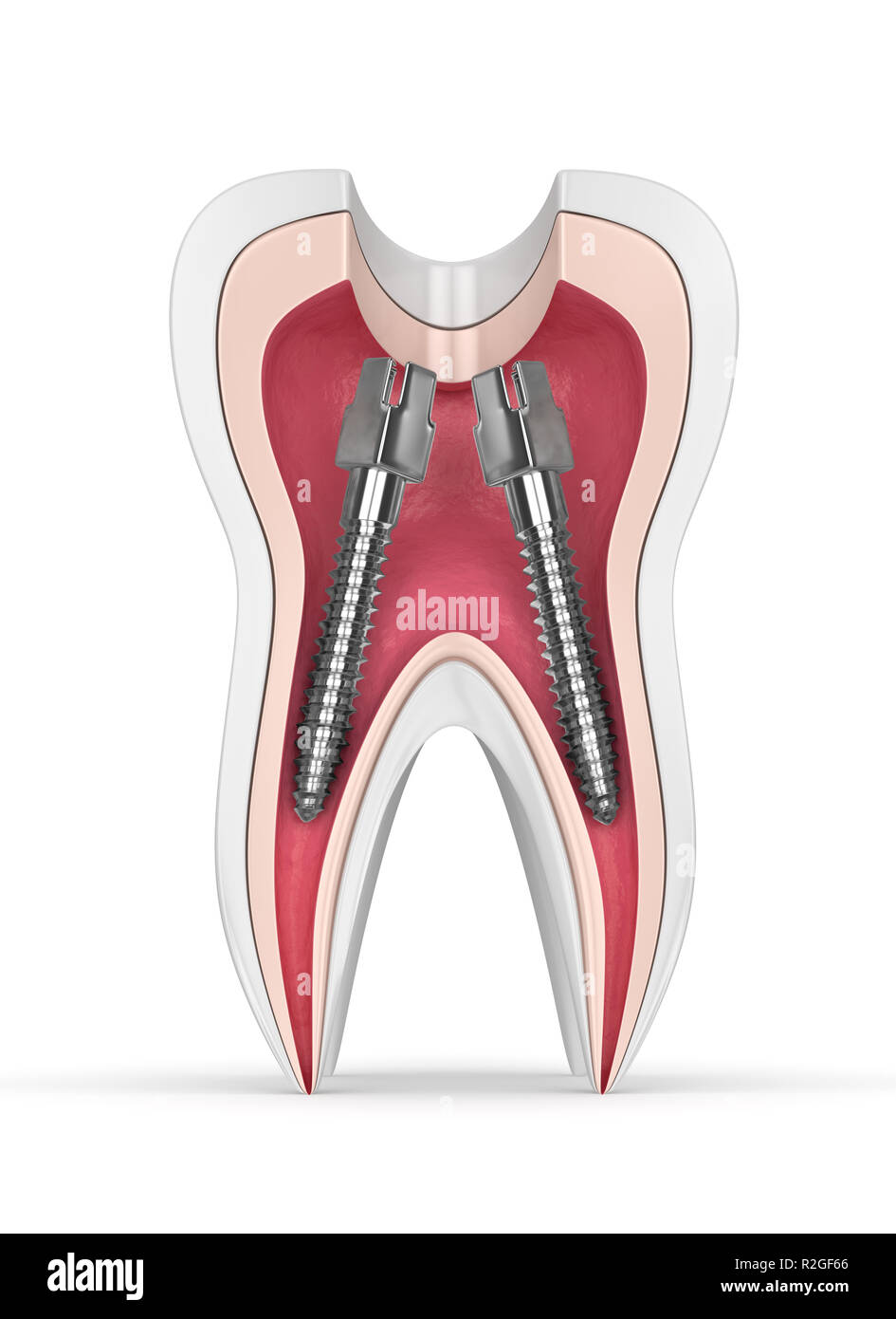 3d render of tooth with dental root canal posts over white Stock Photo ...