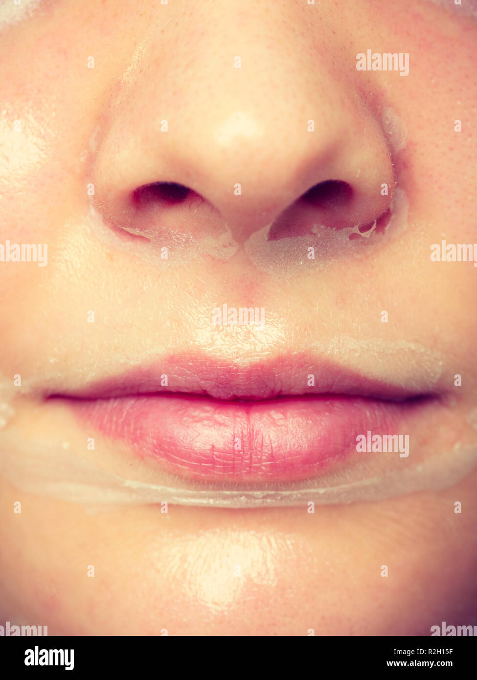 Close up young woman in facial peel off mask, part of face. Peeling ...