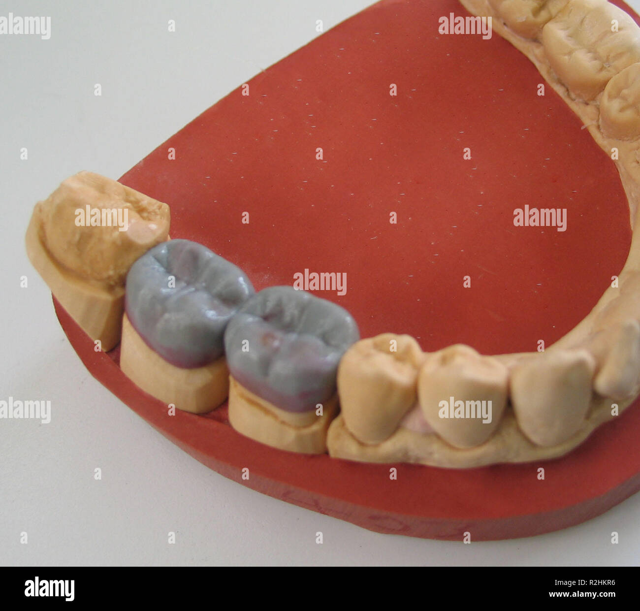 Gold teeth denture hi-res stock photography and images - Alamy