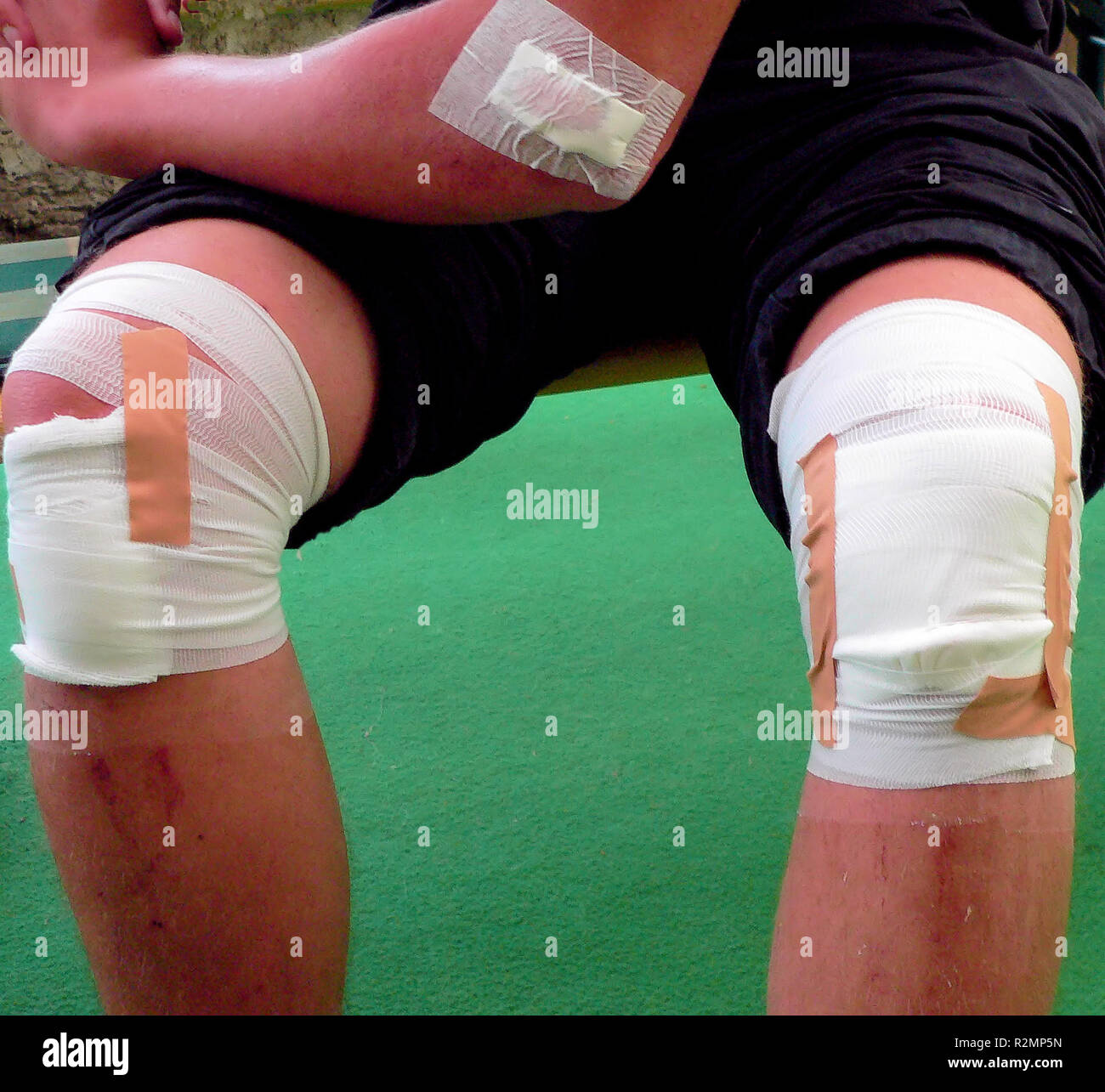 Grazed injury hi-res stock photography and images - Alamy