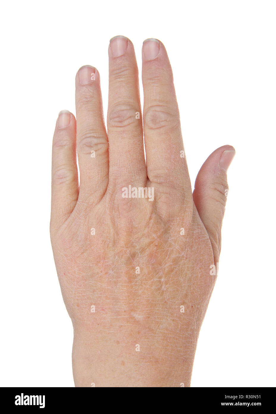 Adult caucasian hand isolated on white background with very dry cracked ...