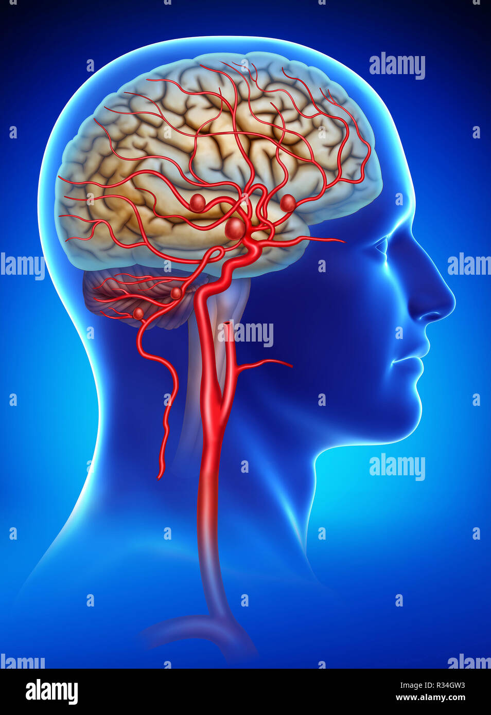 Tipos de aneurismas Stock Photo - Alamy