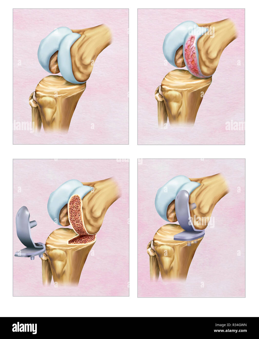 Artrosis dolor de cadera hi-res stock photography and images - Alamy