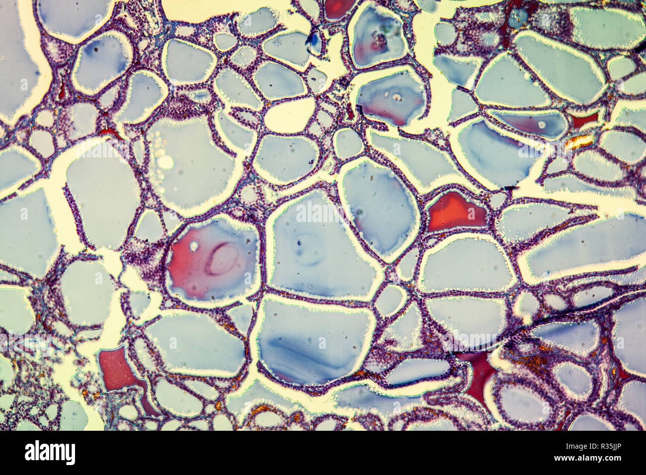 Thyroid goiter hi-res stock photography and images - Alamy