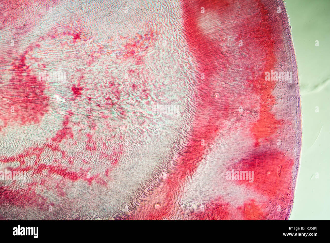 Dentin caries hi-res stock photography and images - Alamy