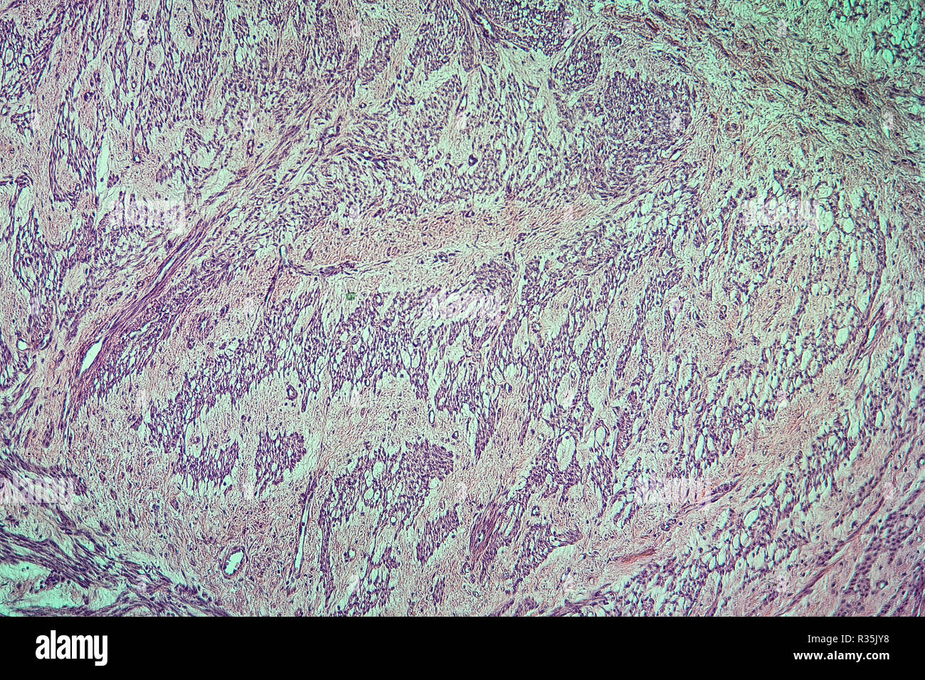 fibromyoma,gutatige tumor of the uterus Stock Photo - Alamy