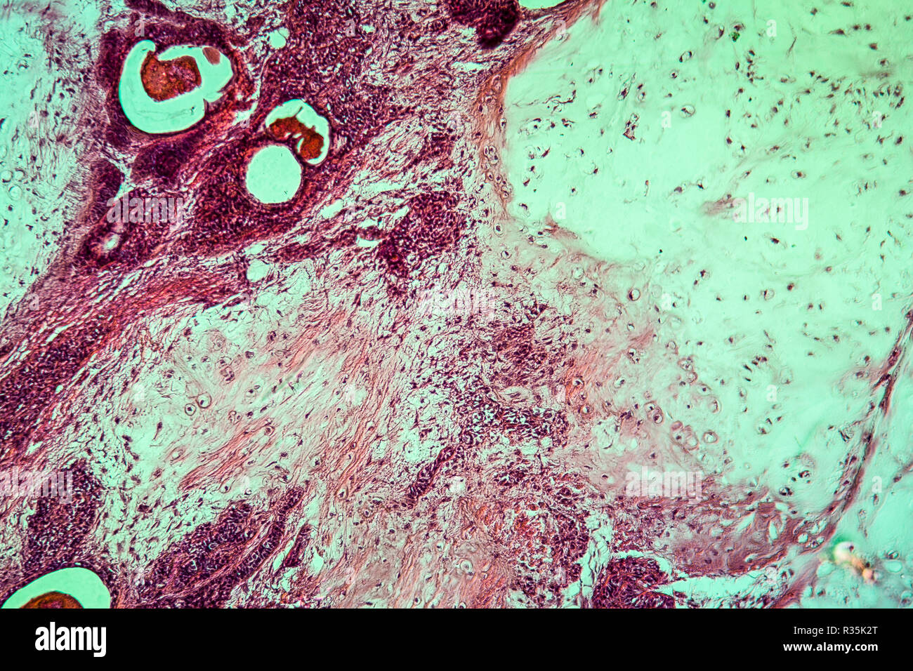 Ear cancer hi-res stock photography and images - Alamy