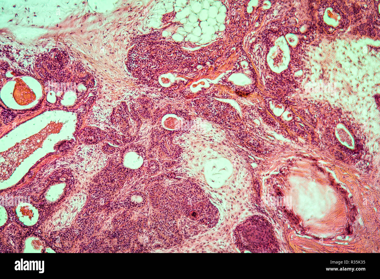 Parotid gland hi-res stock photography and images - Alamy