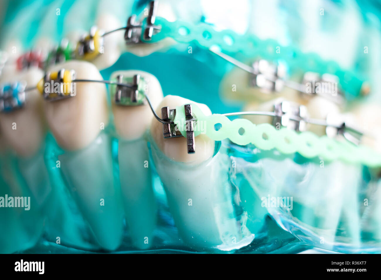 Dental metal braces teeth retainer aligners teaching orthodontics model ...