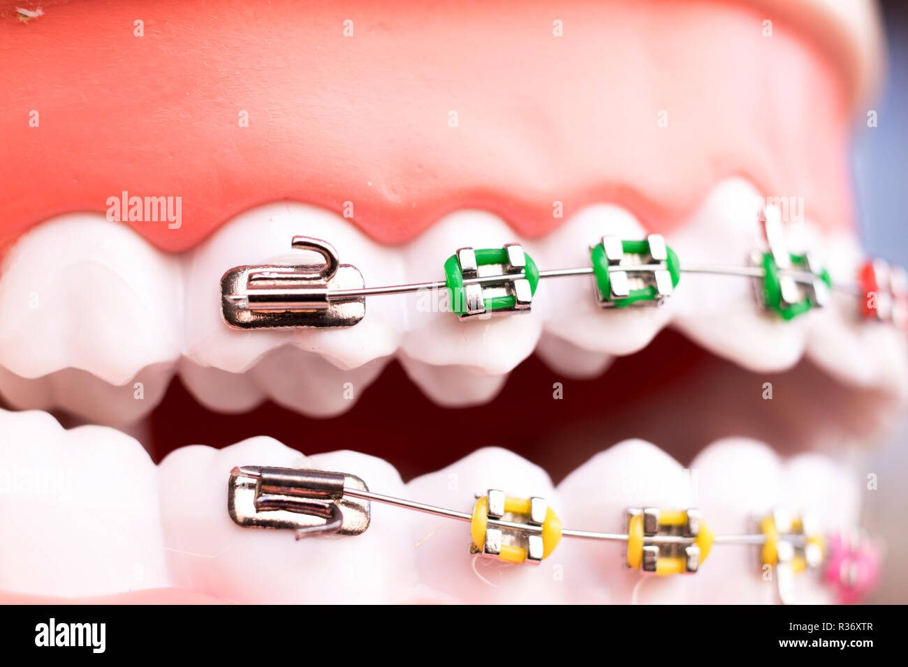 Dental metal braces teeth retainer aligners teaching orthodontics model ...