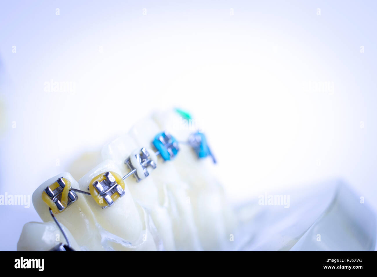 Dental metal braces teeth retainer aligners teaching orthodontics model ...