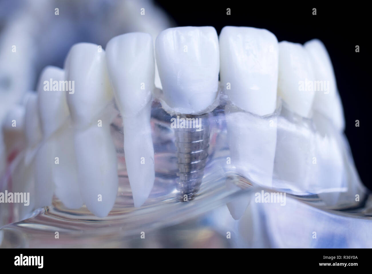 Dentist dental teeth teaching model showing titanium metal tooth ...