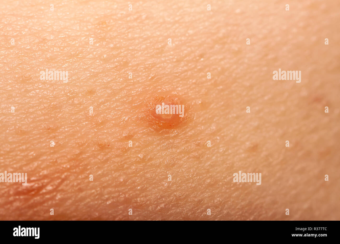 Papules face hi-res stock photography and images - Alamy