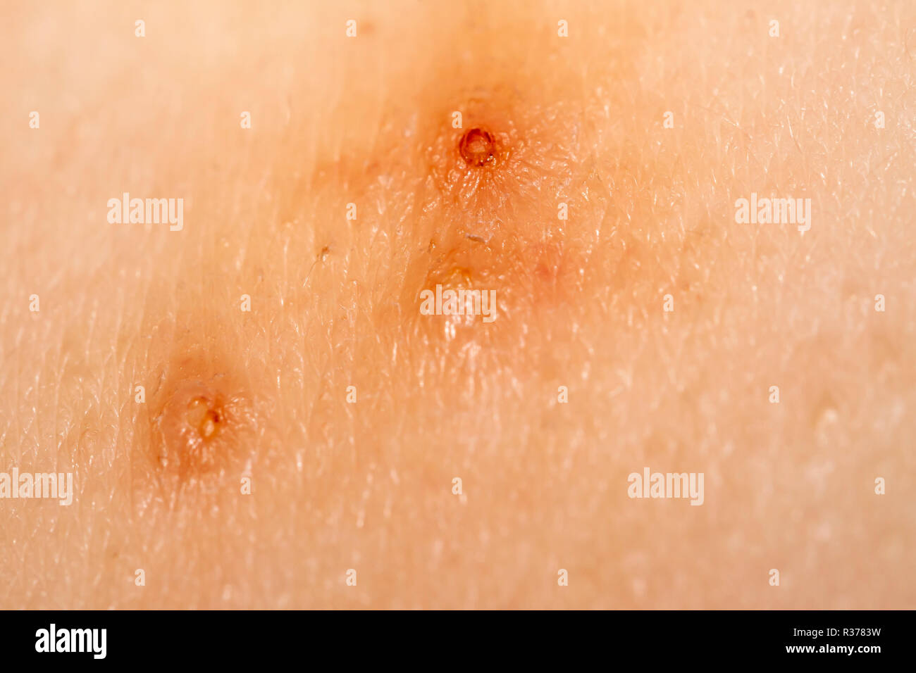 Close up of Molluscum Contagiosum also called water wart Stock Photo ...