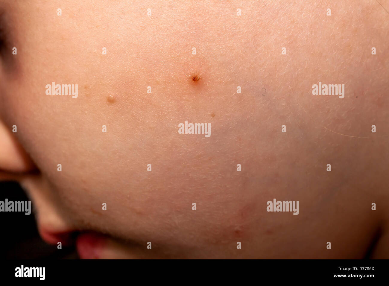 Wart child hi-res stock photography and images - Alamy