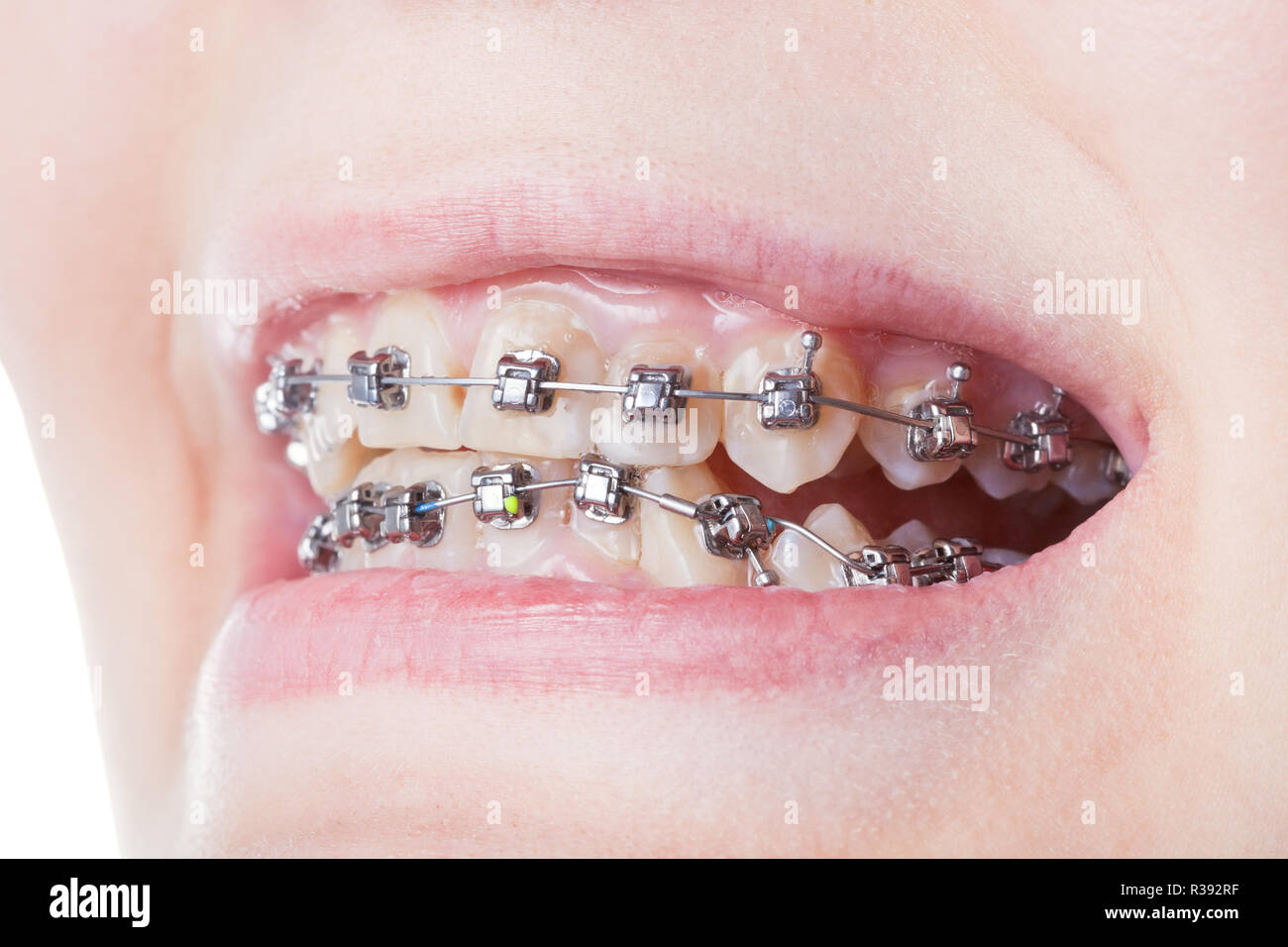 Teeth bite side view hi-res stock photography and images - Alamy