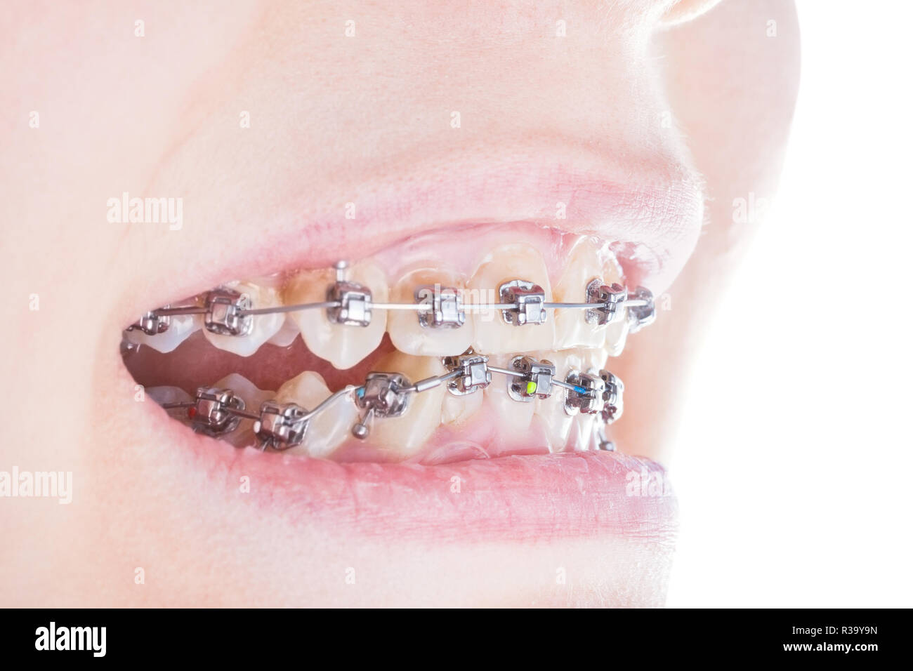 Teeth bite side view hi-res stock photography and images - Alamy