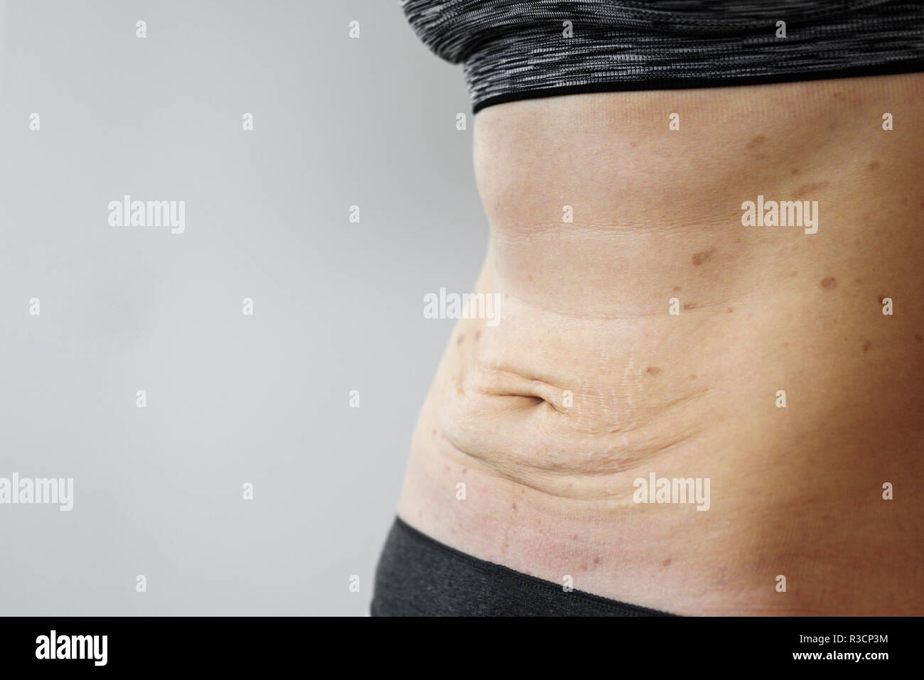 Woman belly with lichen planus, stretch marks. Fat loss Stock Photo - Alamy