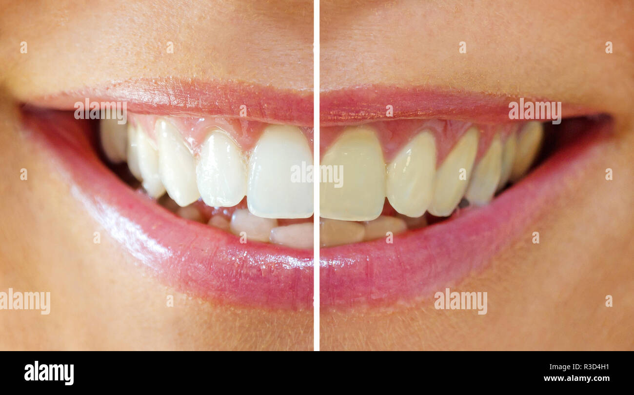 50 teeth hi-res stock photography and images - Alamy