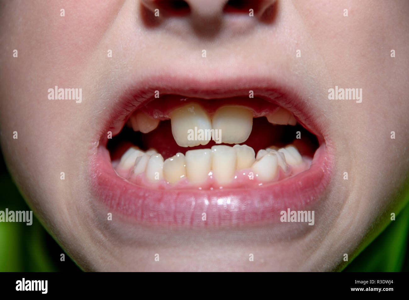 open mouth of a boy with tooth Stock Photo - Alamy