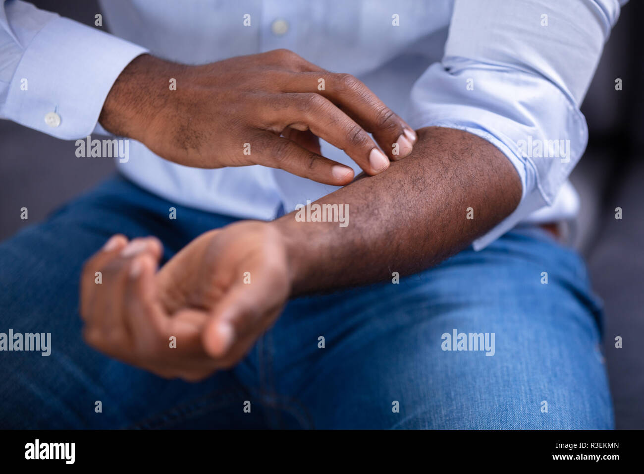 Skin rash african hi-res stock photography and images - Alamy