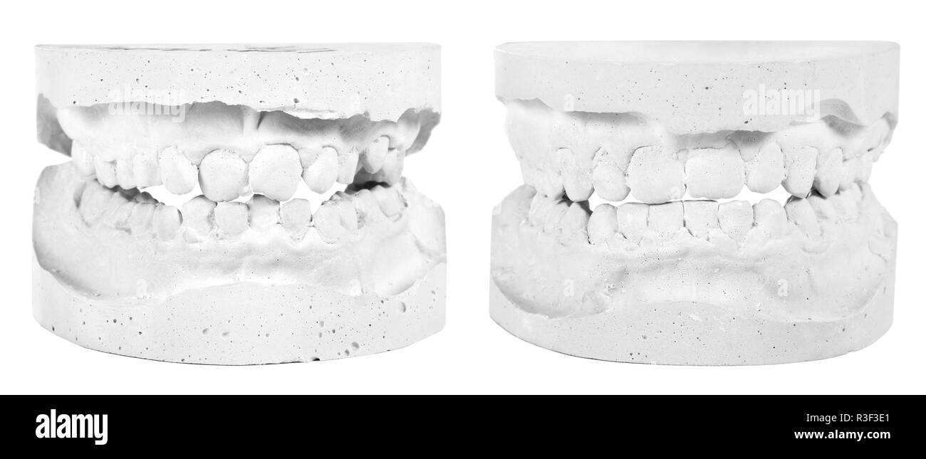 plaster casts before and after treatment Stock Photo - Alamy