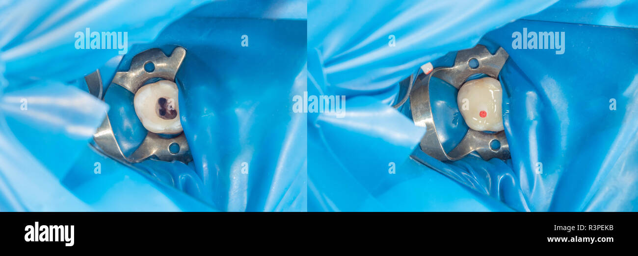 Human teeth close-up during restoration of filling. The concept of ...