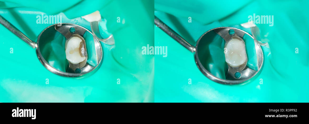 Human teeth close-up during restoration of filling. The concept of ...