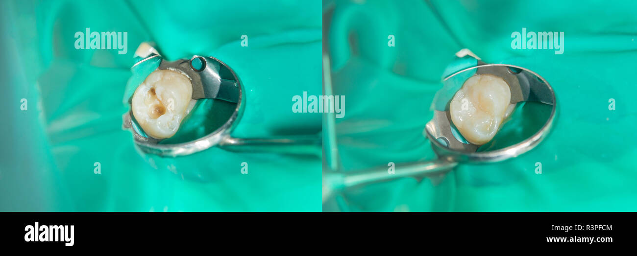 Human teeth close-up during restoration of filling. The concept of ...