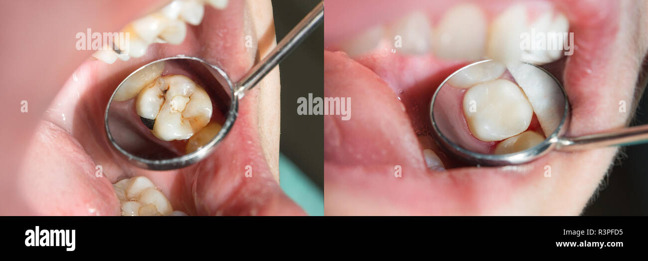Human teeth close-up during restoration of filling. The concept of ...