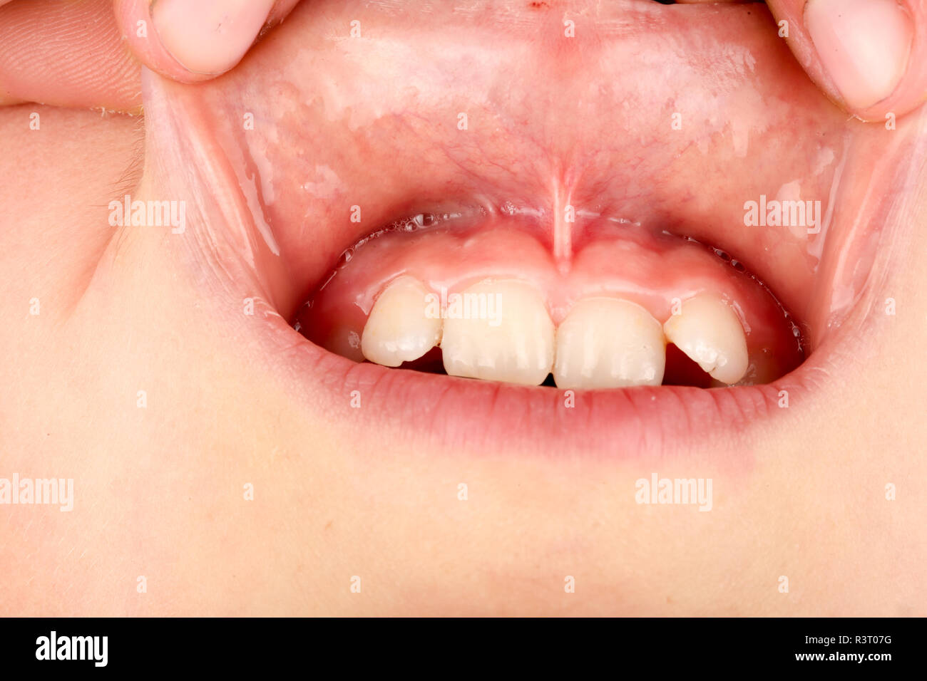 Upper lip hi-res stock photography and images - Alamy
