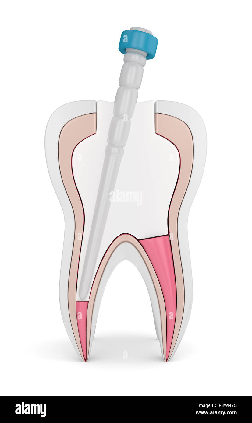 Gutta Percha In Tooth
