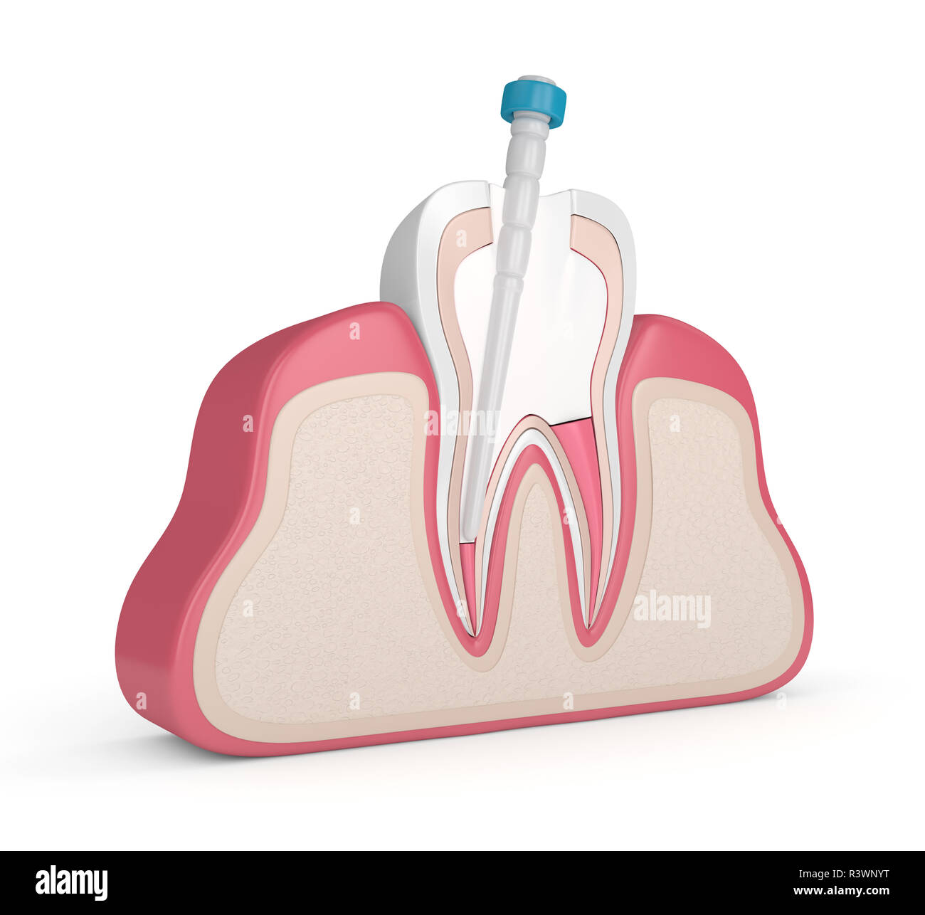 Gutta Percha In Tooth