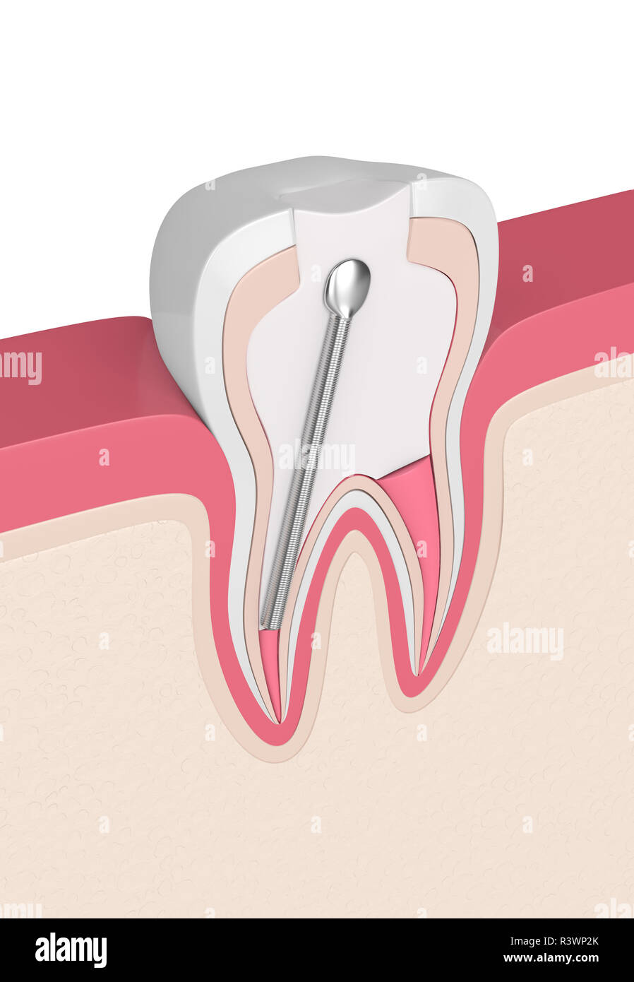 3d render of tooth with stainless steel dental post and filling in gums ...
