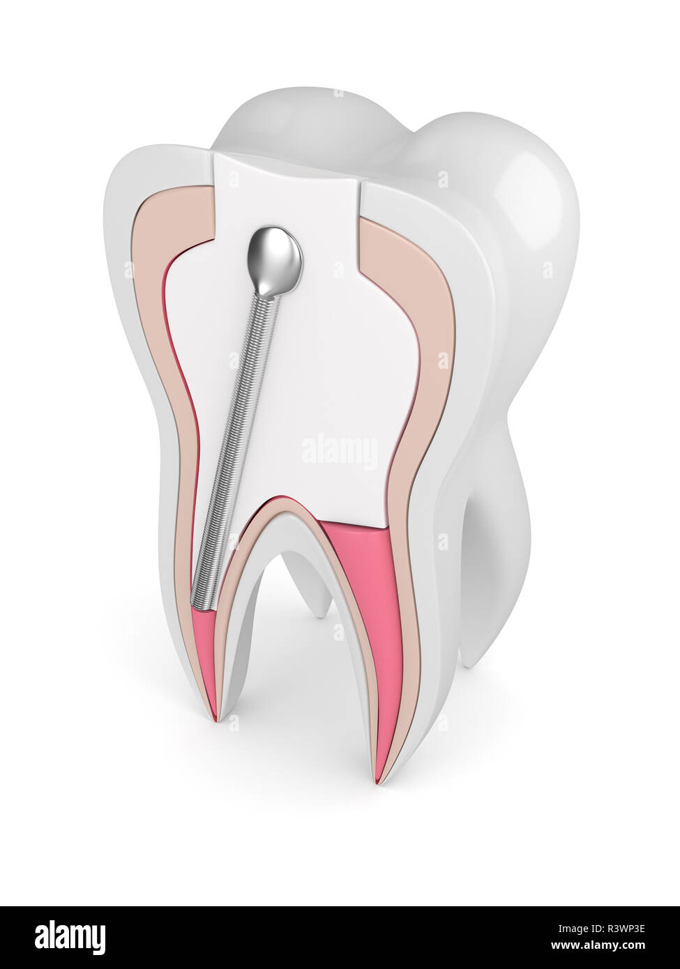 3d render of tooth with stainless steel dental post and filling over ...