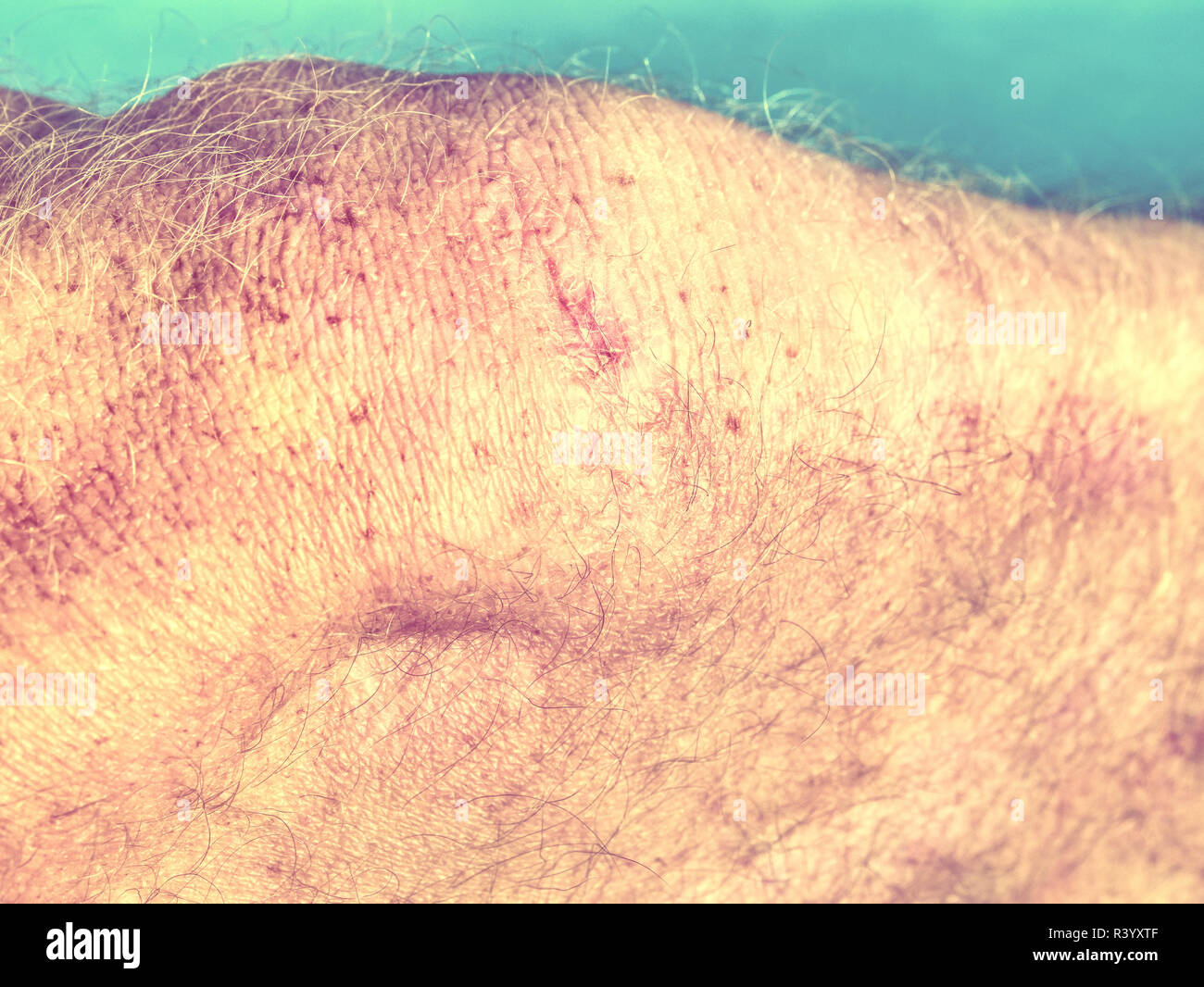 Pink scar on the human skin. Scar on human burned skin from abrassion ...