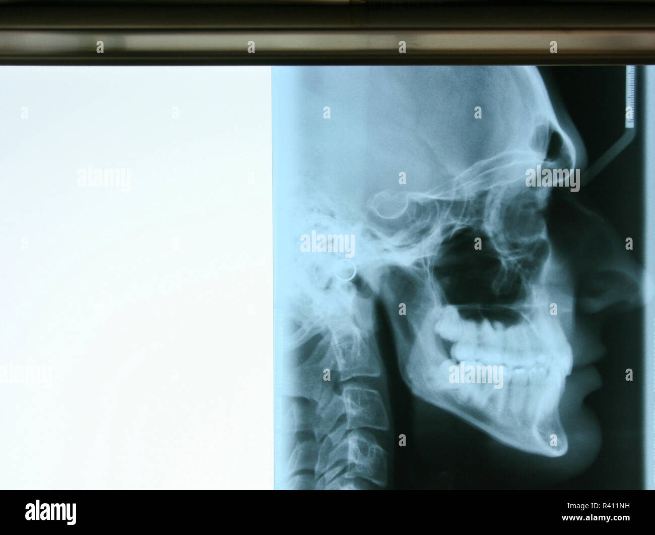 X-ray of human teeth Stock Photo - Alamy
