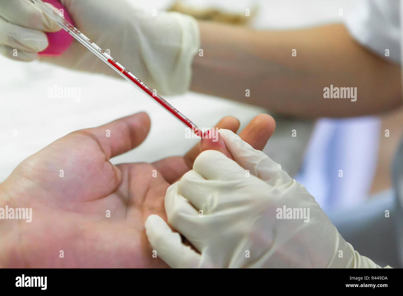 Finger blood test in the laboratory. The doctor pierces a finger. Close ...