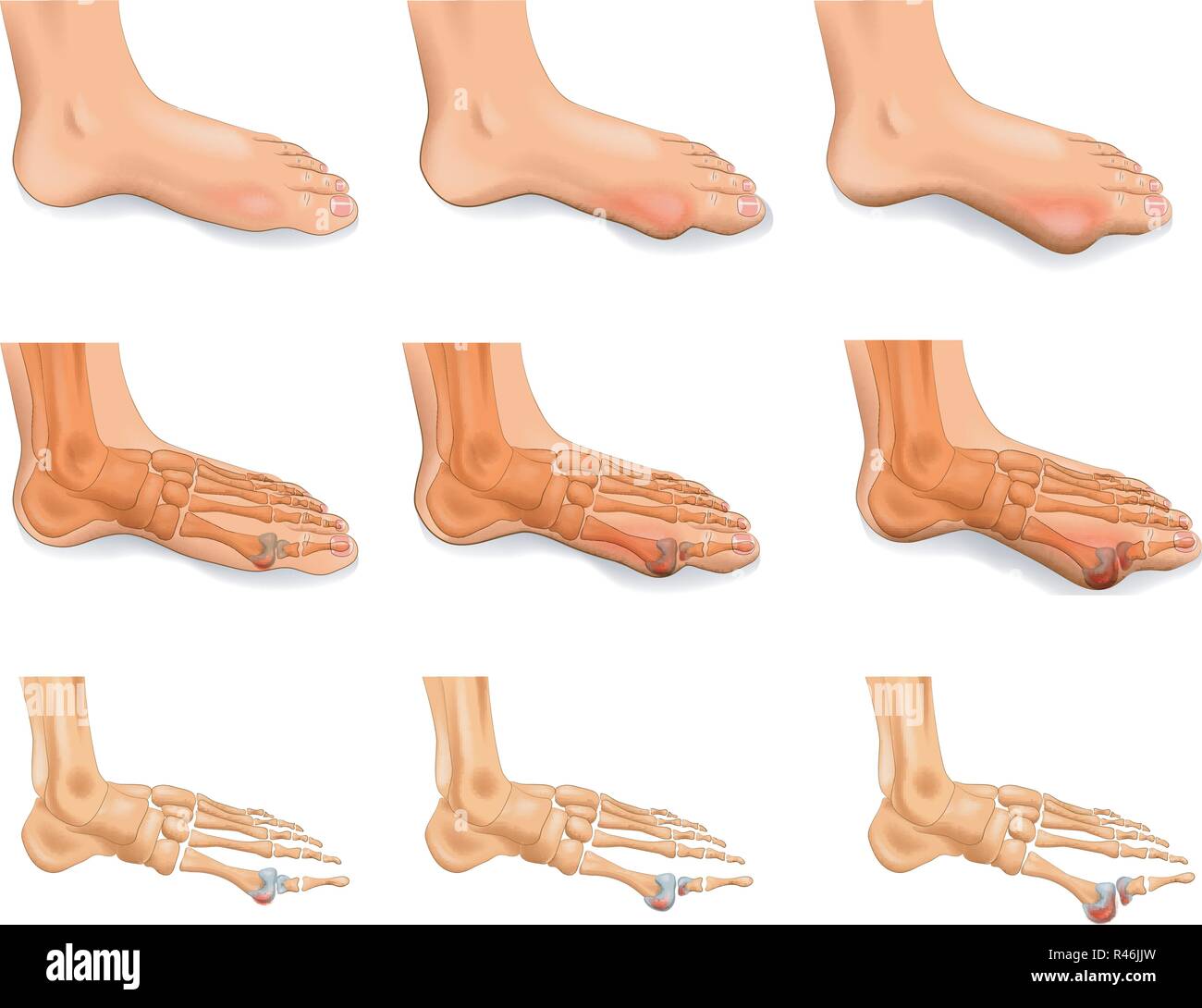 Big toe bump Stock Vector Images - Alamy