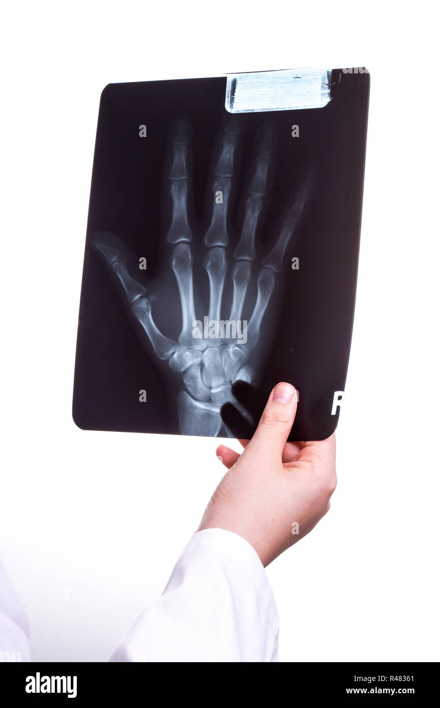 X ray picture of a hand hi-res stock photography and images - Alamy