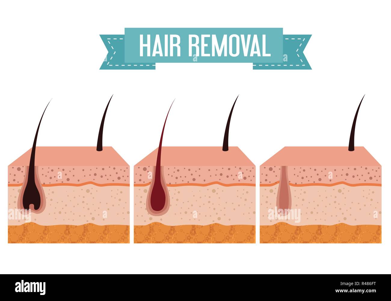 layers skin structure with hair removal icons vector illustration ...